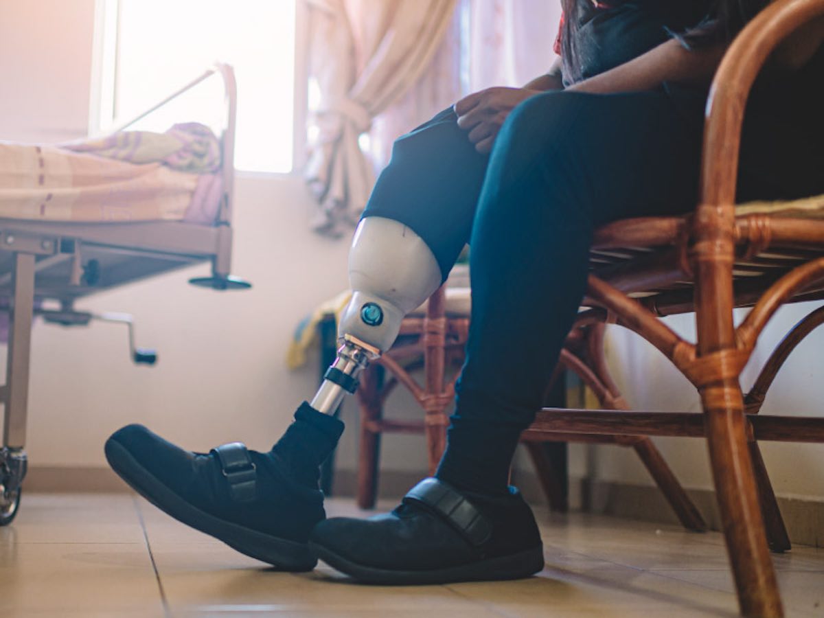 Hispanos adultos son más propensos a sufrir amputaciones por esto